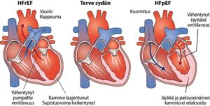 Potilaan omahoito ja omaseuranta, ohje hoitajalle – Siun Soten hoitopolut