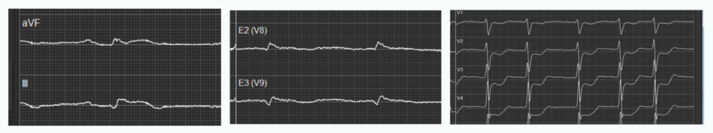 ST-nousuinfarkti – Siun Soten hoitopolut
