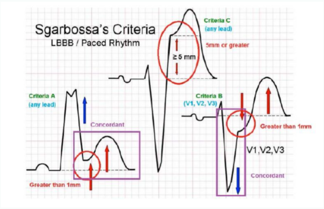 ST-nousuinfarkti – Siun Soten hoitopolut